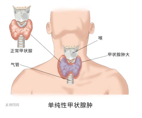 甲状腺 医学插画