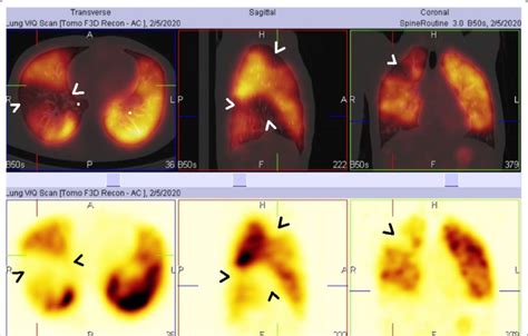 Axial And Reconstructed Views Of Spect Ct Slices Show Multiple Right Download Scientific