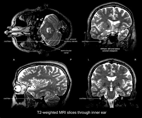 Cochlea On Mri Pharmacology Nursing Audiology Pharmacology
