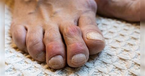 How To Reduce Uric Acid In Winter Do Not Include These Foods In Your