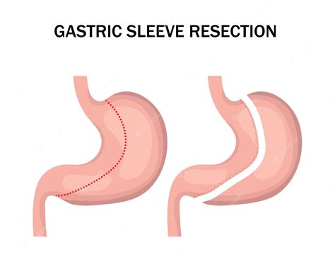 Premium Vector Gastric Sleeve Resection Infographic Stomach