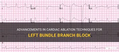 Advancements In Cardiac Ablation Techniques For Left Bundle Branch