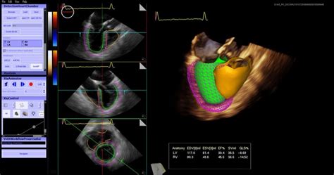 3d Analysis Of The Function Of The Left Ventricle Lv Right Ventricle