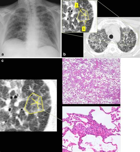 Hypersensitivity Pneumonitis A Chest Radiograph Showed Patchy Download Scientific Diagram