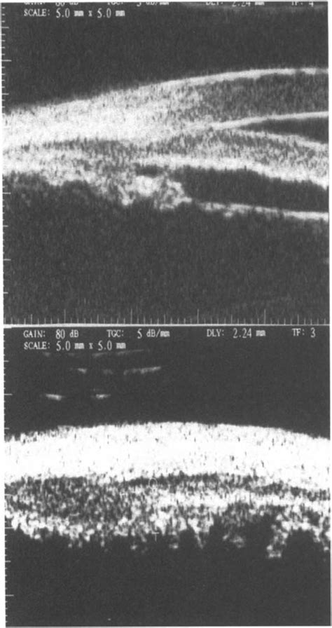 Hypotony In Two Patients With Cataracts Ubm Findings In Two Sisters Download Scientific