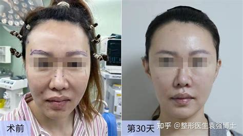 拉皮手术到底能维持几年能年轻多少岁都是大实话 知乎