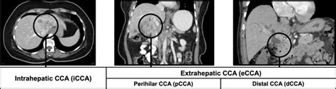 Cholangiocarcinoma Subtypes Download Scientific Diagram