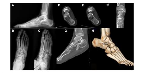 Preoperative Imaging Data Of The Right Foot Showed A Tarsal Navicular Download Scientific