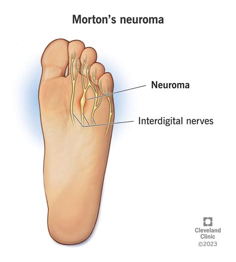 Sore Ball Of Foot Causes Symptoms Best Home Treatment 49 Off