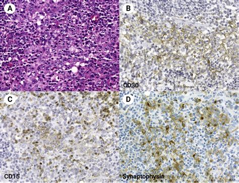 Classic Hodgkin Lymphoma Involving A Mediastinum Case 1 Light