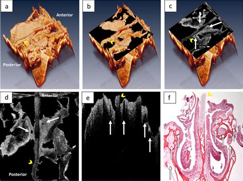 3d Reconstruction Of Olfactory Cleft With Demonstration Of Olfactory