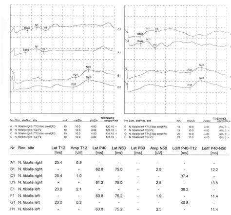 Prolonged Latencies And Distorted Shapes On Bilateral T12 Eps And