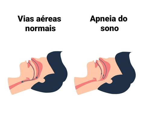 Apneia Do Sono O Que é Sintomas Causas Tratamento E Prevenção