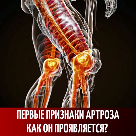 Первые признаки артроза Как он проявляется Реабилитация Online Дзен