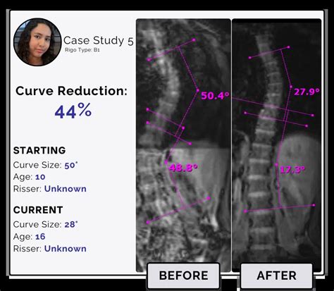 Results By Curve Reduction Scoliosis Care Centers