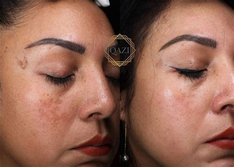 Hyperpigmentation Treatment In Newport Beach Qazi