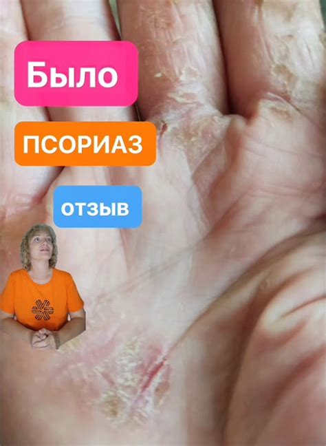 Лечение псориаза псориаз лечениепсориаза лечениепсориазапрепаратами