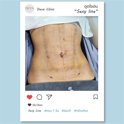 รีวิวหลังดูดไขมัน Sexy Line ทำไปแค่ 7 วัน ร่องขึ้นค่อนข้างชัดแล้ว แต่