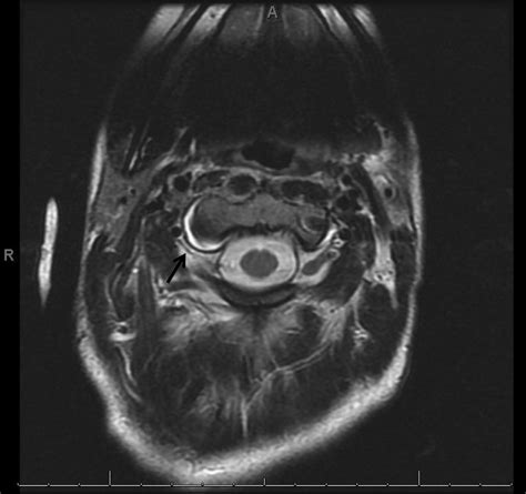 Axial View Of Mri Of Cervical Spine Showing T2 Hyperintense Signal At