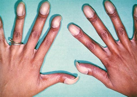Clubbing Of The Fingers Causes