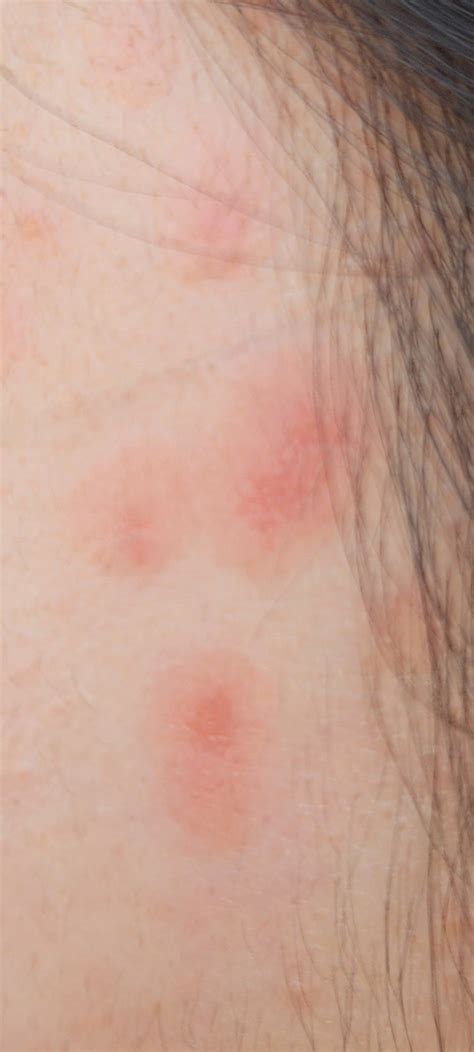 얼굴에 여드름이랑 이런게 있어요 어떻게 지식in