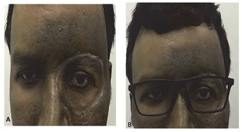 A Rehabilitation Of The Orbital Socket With Prosthesis B Glasses Download Scientific