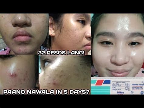 Paano Nawala Ang Pimples At Acne Scar Ko In Days Bioderm Ointment Youtube