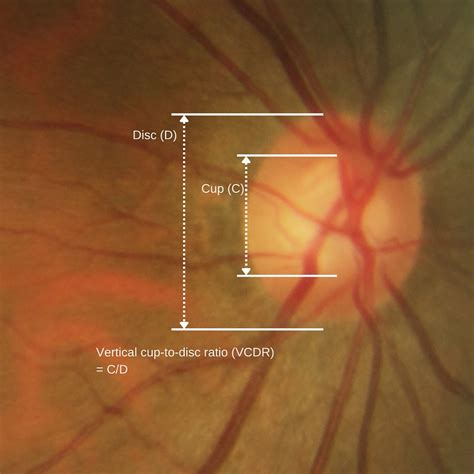 An Illustration Of The Optic Nerve Head Onh And The Vertical