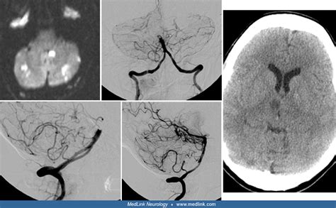 Basilar Artery Stroke Medlink Neurology