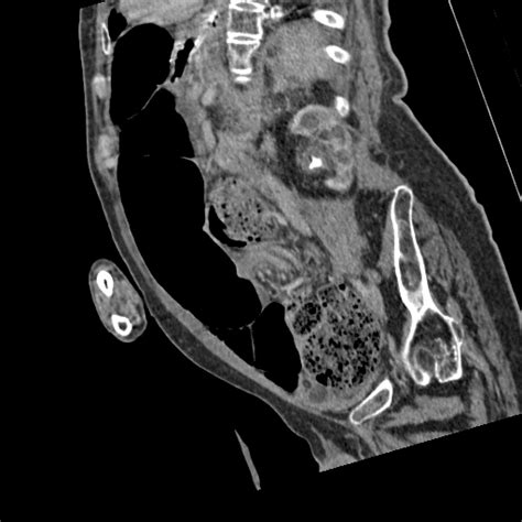 Sagittal Oblique Multiplanar Reformatted Image Demonstrating Sigmoid