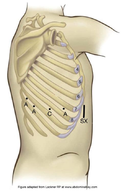 Figure 1 From Sequential Robotic Assisted Lung Resection With A Subxiphoid Utility Incision