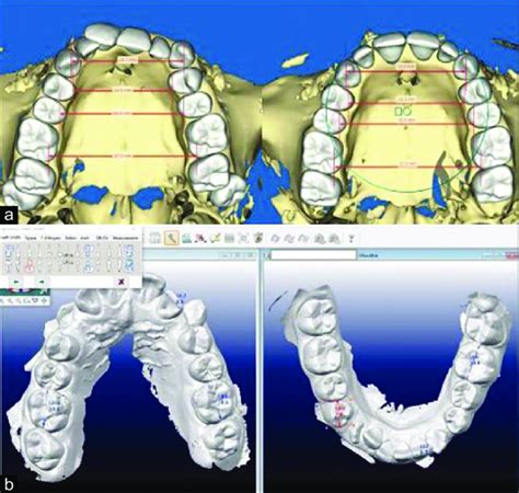 Digital Reconstructions Of Dentures Based On A Cone Beam Computed Download Scientific