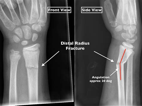 What Makes A Pediatric Wrist Fracture Different