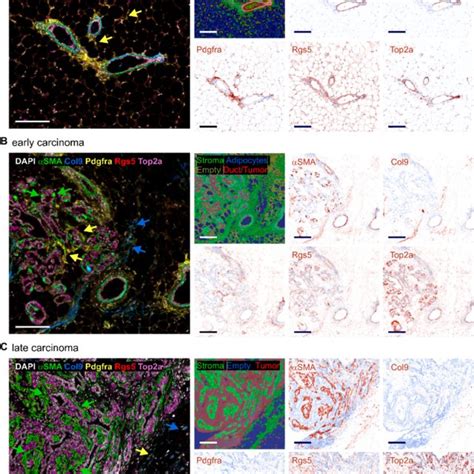 Histology Of Cancer Associated Fibroblast Caf Subset Marker