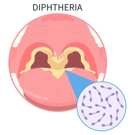 Diphtheria Chiid Health