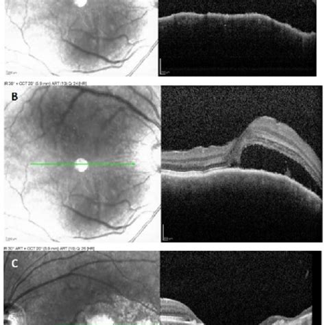 Oct Imaging Of The Macula At Presentation In A B The Right Eye