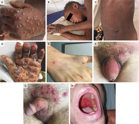 Monkeypox Nejm