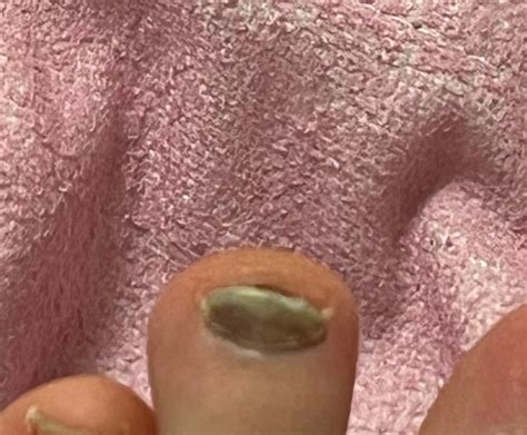 발톱 멍 이거 뭐죠 지식in