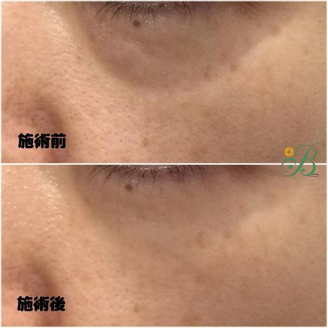 【目の下のたるみ取り】 ブログ 柏の美容皮膚科ならbellis Skin Clinic