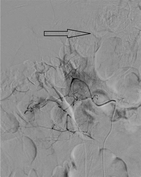 Right L1 Angiogram Using Mikaelsson Catheter Artery Of Adamkiewicz