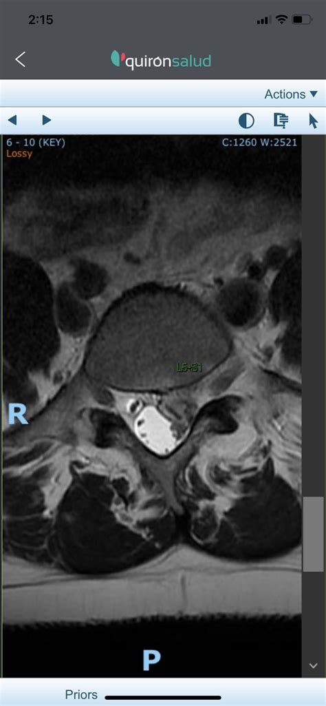 Md Vs Fusion Surgery R Sciatica