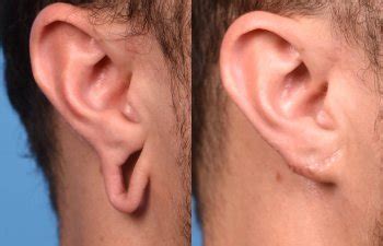 Treating Stretched Or Torn Earlobes Salt Lake City UT