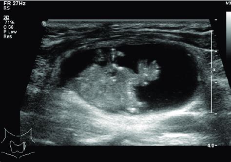 A Mixed Echoic Nodule With Papillary Shape The Image Shows The Solid Download Scientific