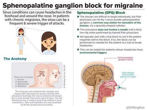 Sphenopalatine Nerve Block
