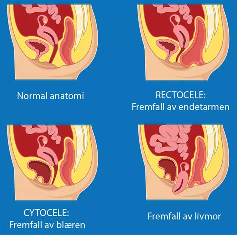 Fremfall Av Skjeden