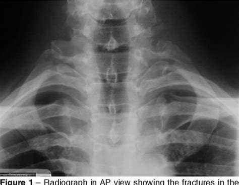 Figure 1 From Bilateral First Rib Fracture In A Dive With Life Vest Semantic Scholar