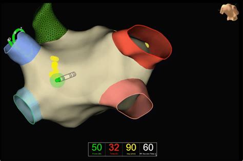 atrial mapping