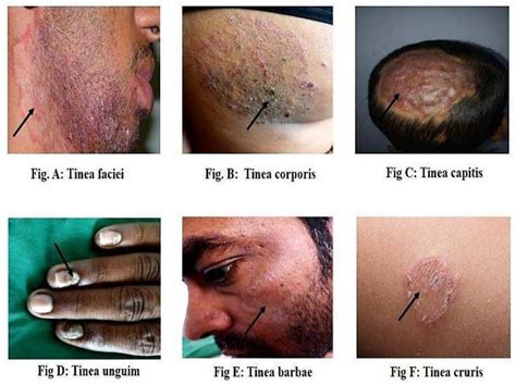 Clinical Pictures Of Dermatophytosis Infection A Tinea