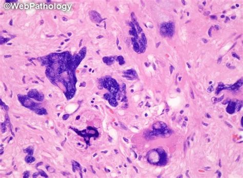 Undiff Pleomorphic Sarcoma Microscopic