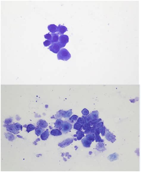 Acantholytic Cell In Tzanck Smear Of Erosive Oral Lesions In Pemphigus